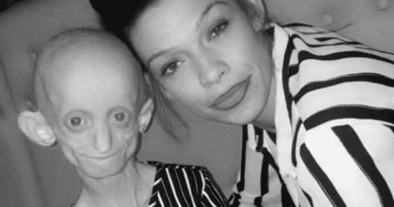 Hutchinson Gilford Progeria Syndrome Body
